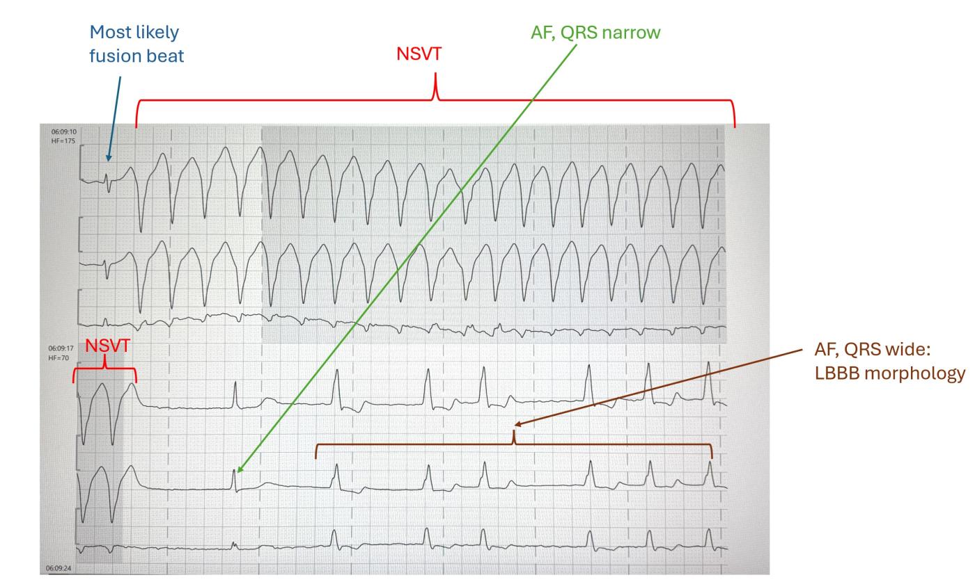 VENTRICULAR TACHYCARDIA, ATRIAL FIBRILLATION AND ABERRANT CONDUCTION | ECG Guru - Instructor ...